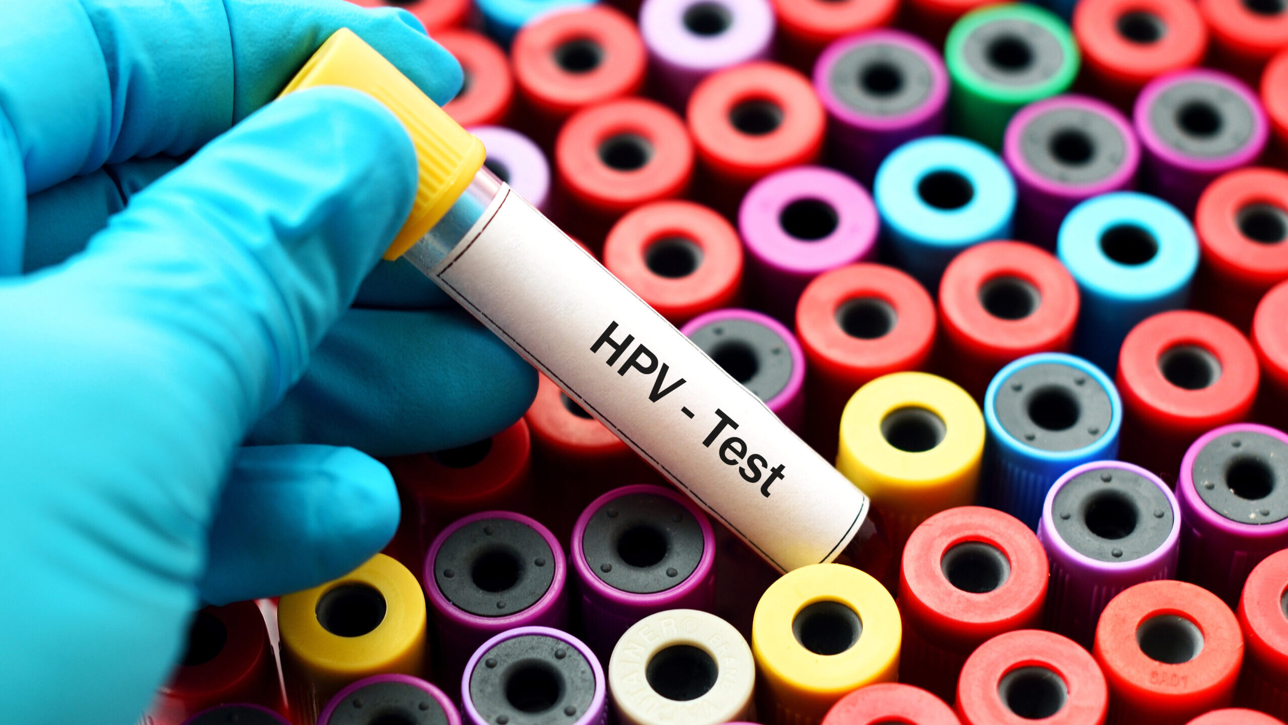 How new at-home HPV test kits could help Alabama fight cervical cancer ...